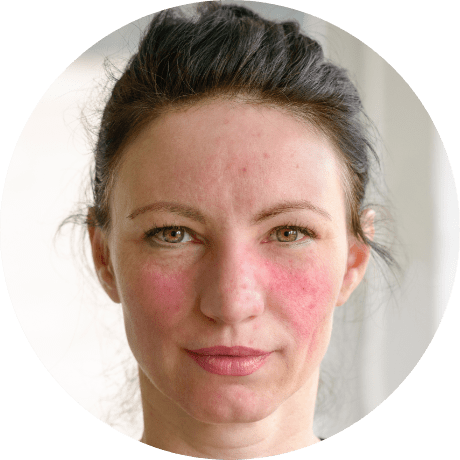 Mild Rosacea On Cheeks